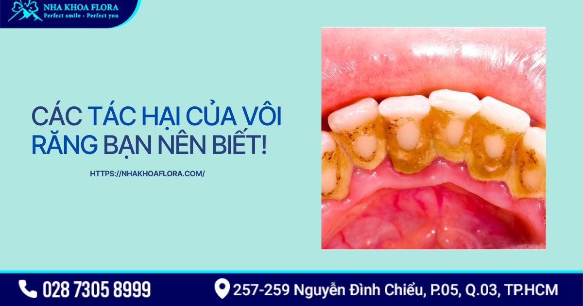 Tác Hại Của Vôi Răng đến Sức Khỏe Răng Miệng