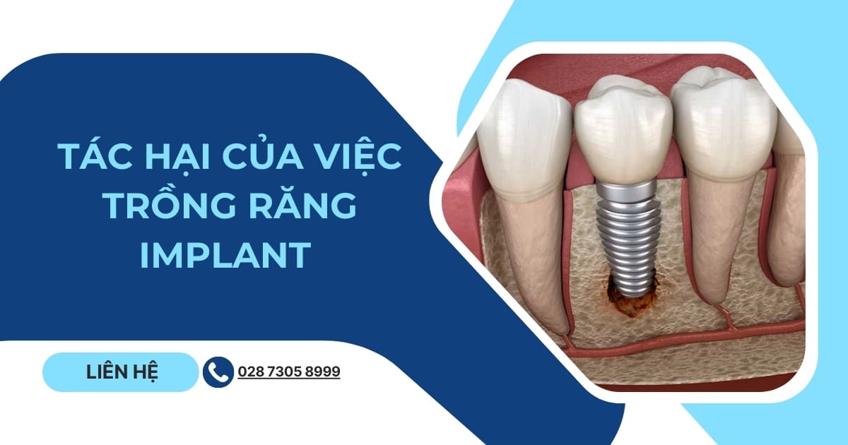 5 Tác Hại Của Việc Trồng Răng Implant Bạn Cần Biết Trước