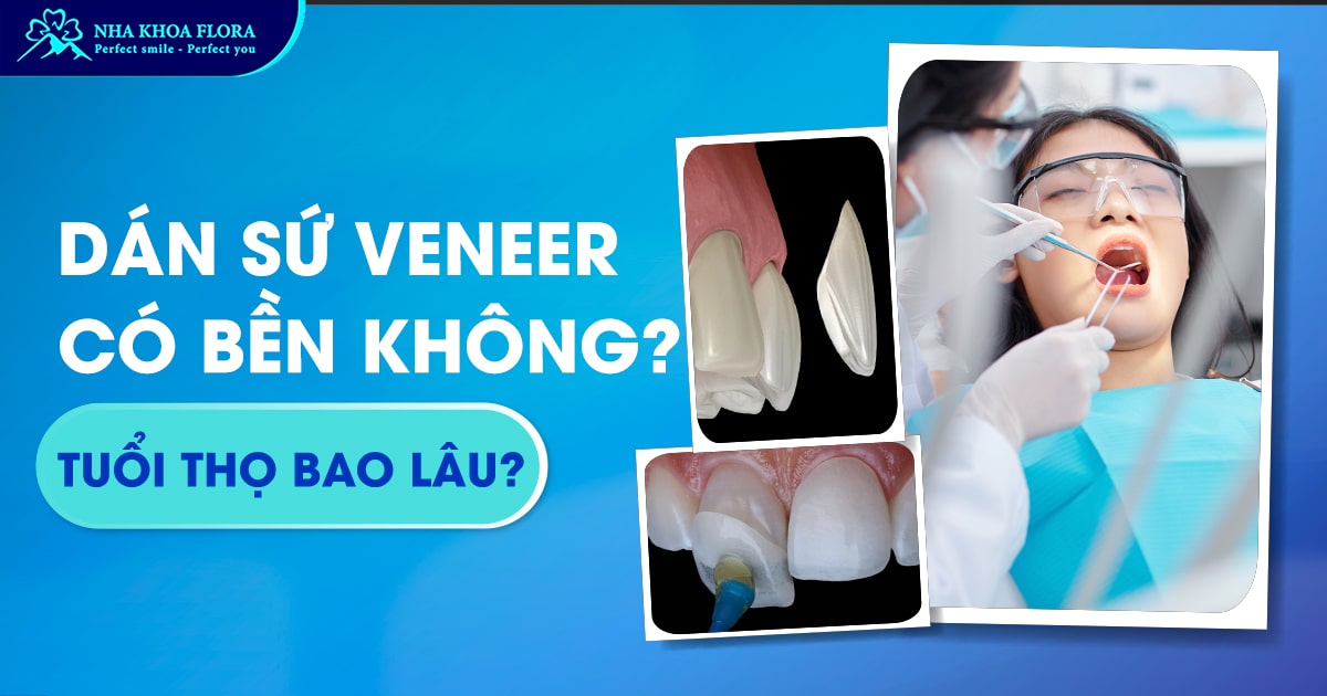 Dán Sứ Veneer Có Bền Không? Tuổi Thọ Duy Trì được Bao Lâu?