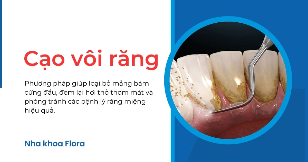 Cạo Vôi Răng Là Gì? Khi Nào Nên Cạo Vôi Răng? Giá Bao Nhiêu?