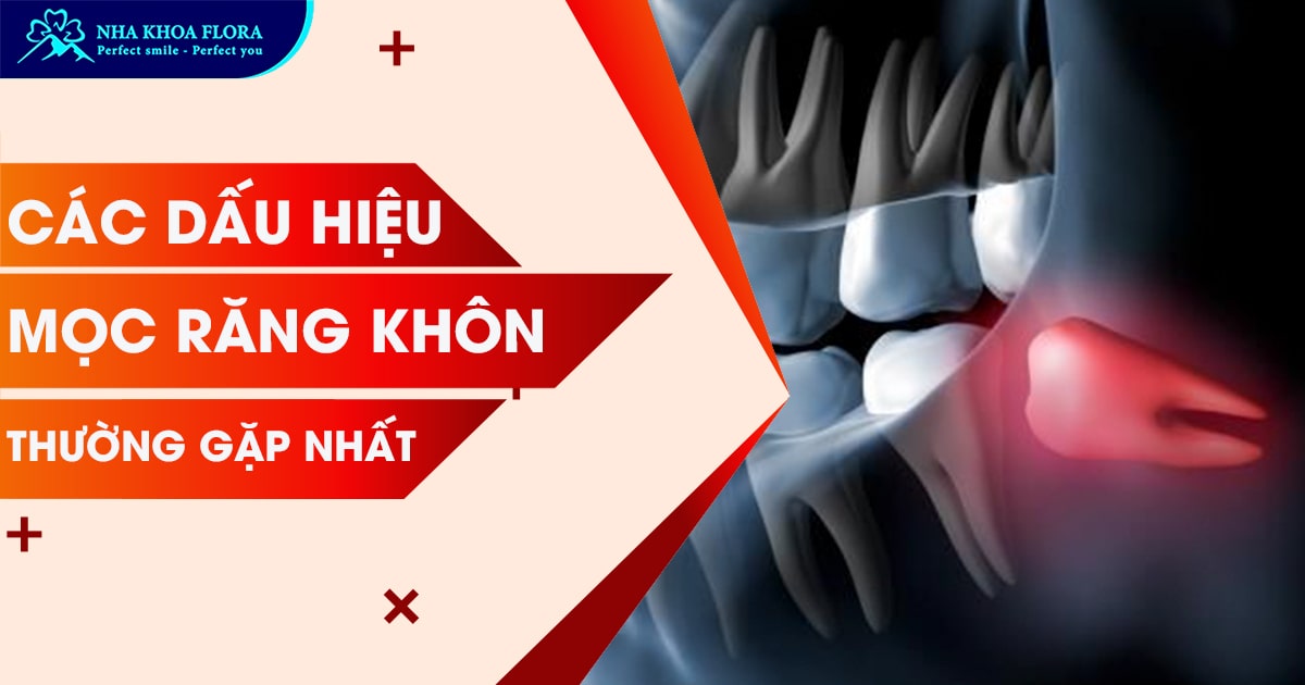 Các Dấu Hiệu Mọc Răng Khôn Thường Gặp Nhất