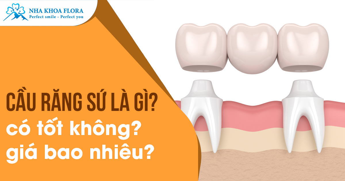Cầu Răng Sứ Là Gì? Có Tốt Không? Giá Bao Nhiêu Tiền?