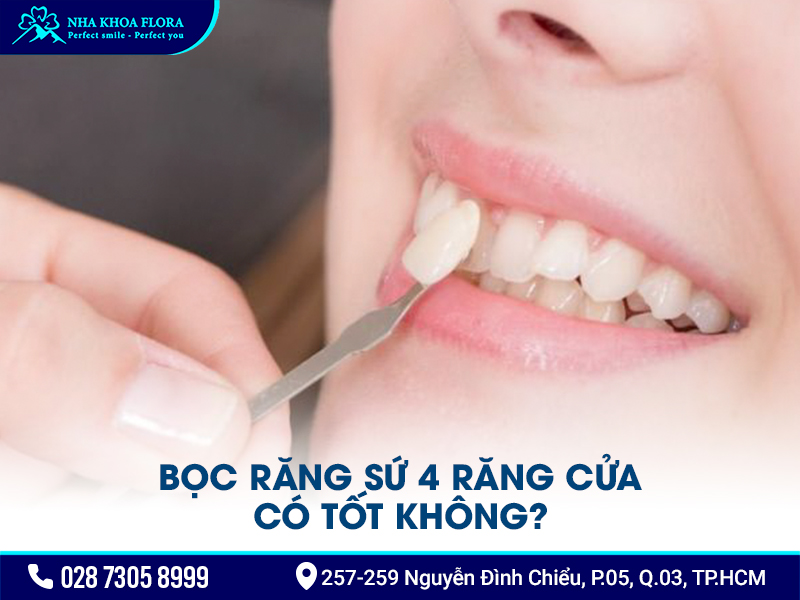 Làm Răng Sứ 4 Răng Cửa Có Tốt Không? Giá Bao Nhiêu?