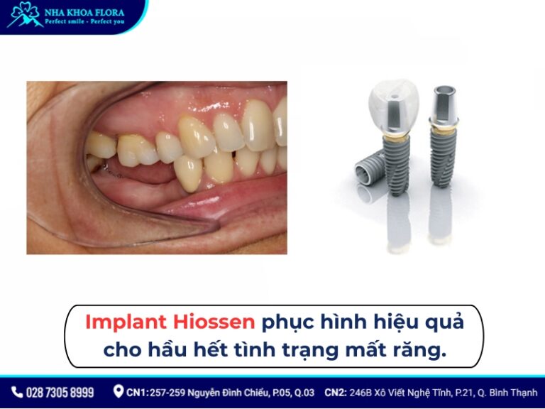 Trụ Implant Hiossen Có Tốt Hay Không? Giá Bao Nhiêu Tiền?
