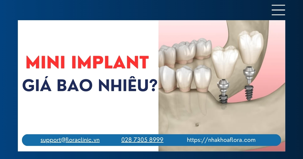 Mini Implant Giá Bao Nhiêu? Báo Giá Mới Nhất 2024