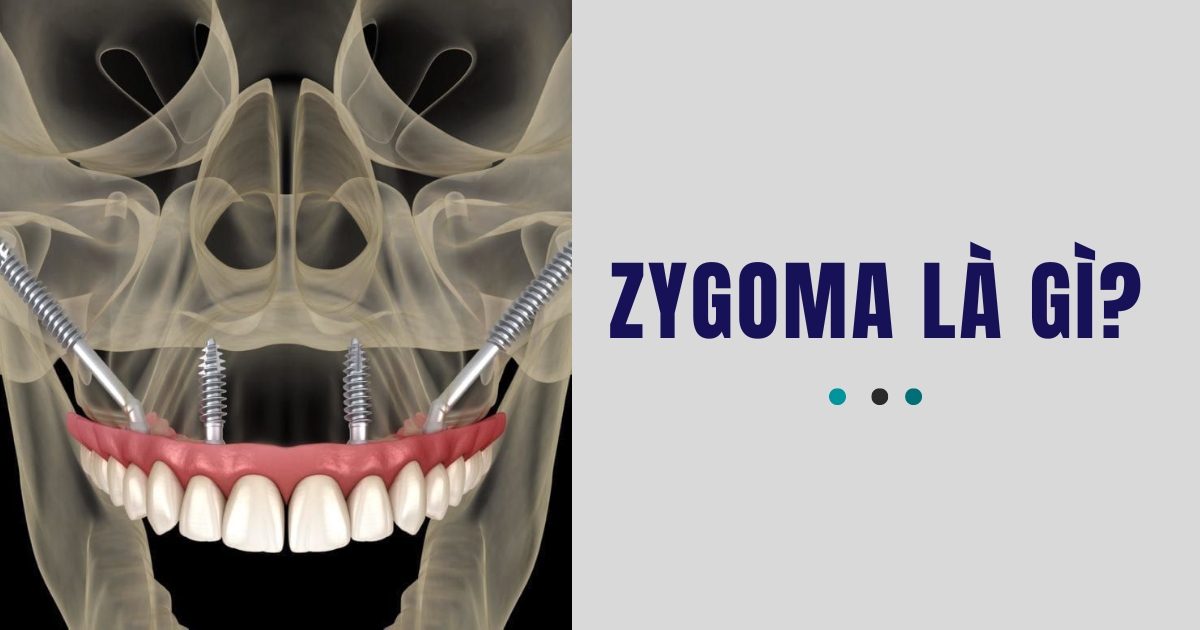 Zygoma Là Gì? Ai Cần Thực Hiện? Chi Phí Bao Nhiêu Tiền?
