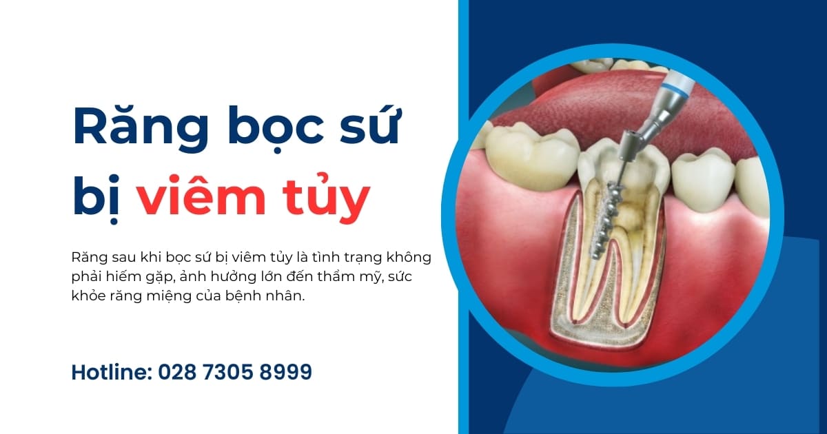 Răng Bọc Sứ Bị Viêm Tủy Do đâu? Cách điều Trị Như Thế Nào?