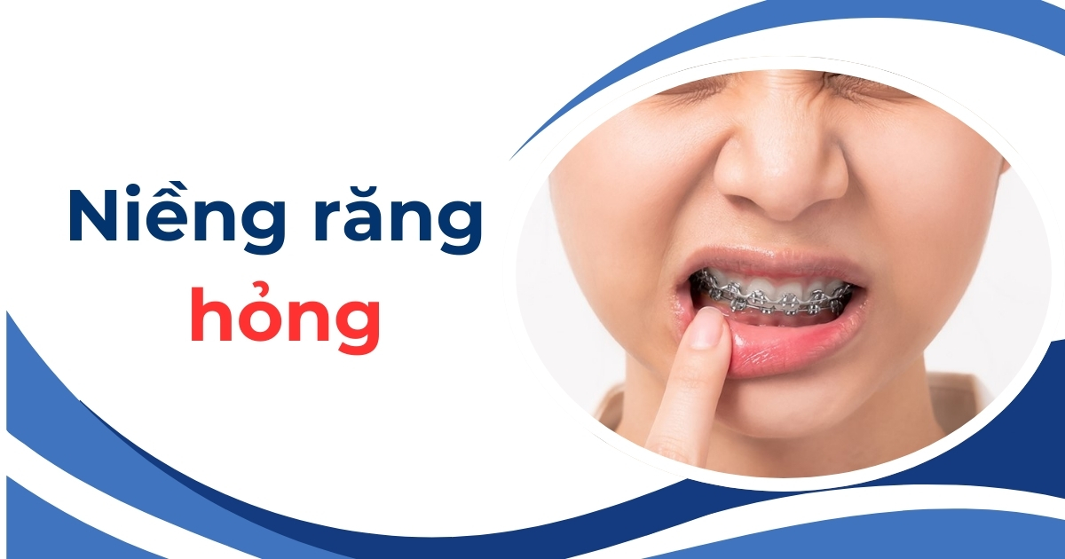 Niềng Răng Hỏng: Dấu Hiệu, Nguyên Nhân & Cách Khắc Phục